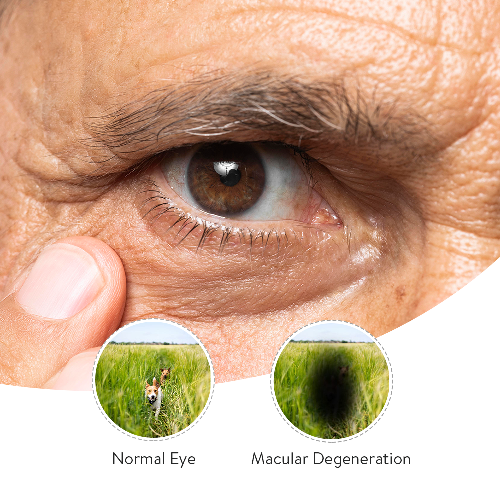 Macular Degeneration: Types, Treatment and Precaution – Lifezen Healthcare